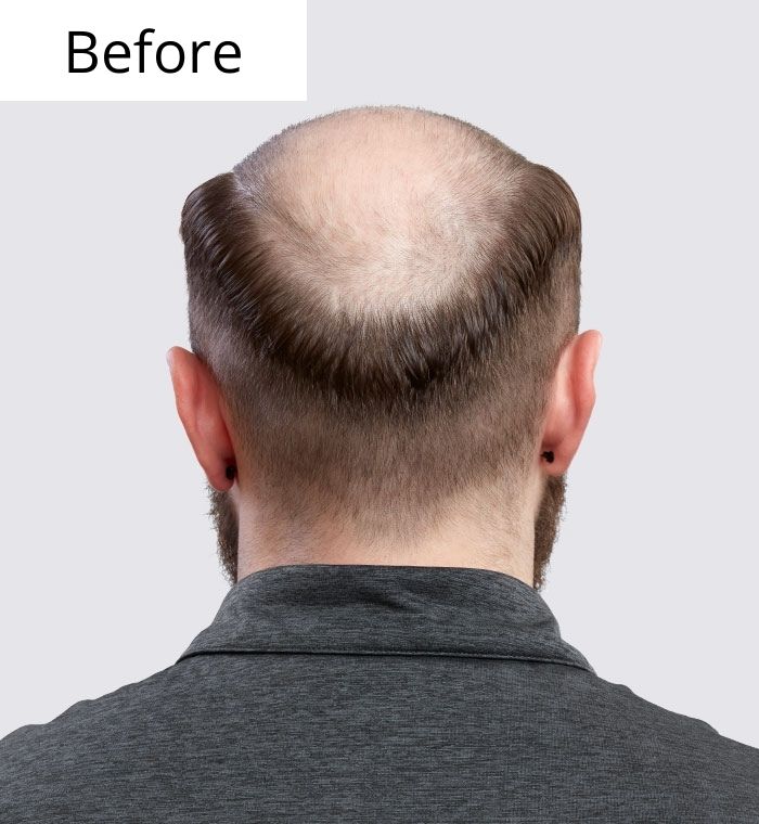 Bonded Toppers for Men | Tammy Lobato Pty Ltd